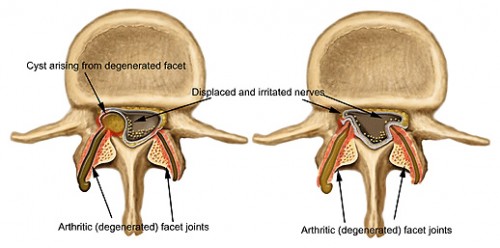 Portsmouth and Chichester Spine Surgeon | SpineInfo.co.uk | Facet Joint ...